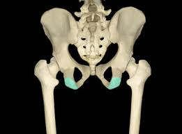 Ischial tuberosity bursitis 엉덩이 통증 : 네이버 블로그