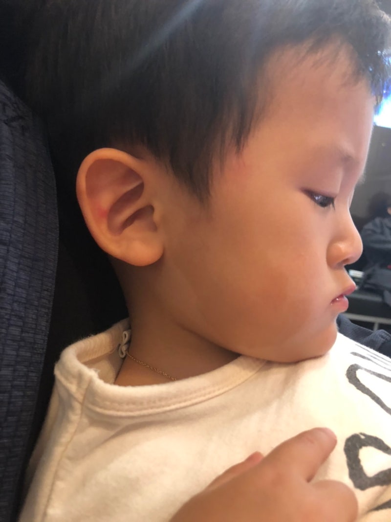 아기 밀크커피반점 갈색점 카페오레반점 레이저치료 경과 기록 네이버 블로그