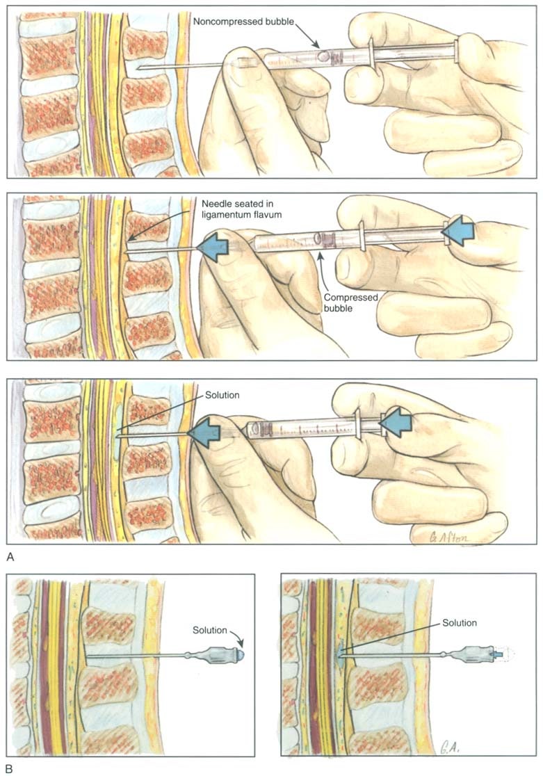 경막외 신경차단술(Epidural nerve block) : 네이버 블로그
