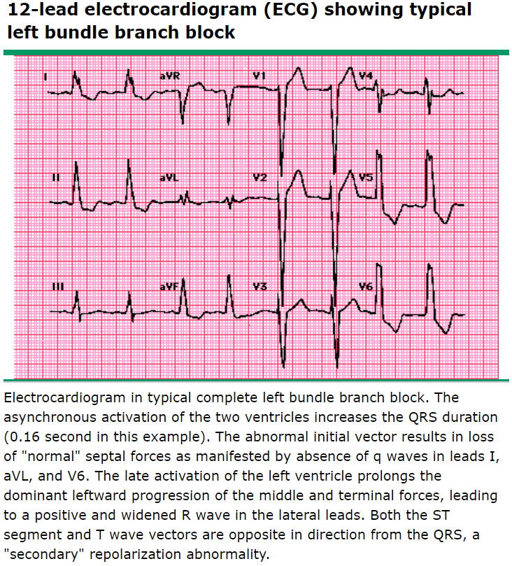 [심전도 Case] LBBB(좌각차단), RBBB(우각차단) 심전도 분석, 진단적 접근 : 네이버 블로그
