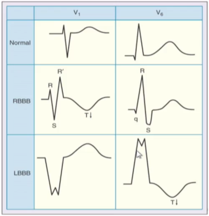 [심전도 Case] LBBB(좌각차단), RBBB(우각차단) 심전도 분석, 진단적 접근 : 네이버 블로그