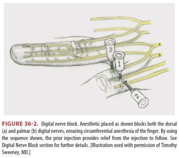 Digital blocks 손가락 신경차단술 : 네이버 블로그