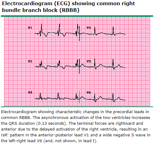 [심전도 Case] LBBB(좌각차단), RBBB(우각차단) 심전도 분석, 진단적 접근 : 네이버 블로그