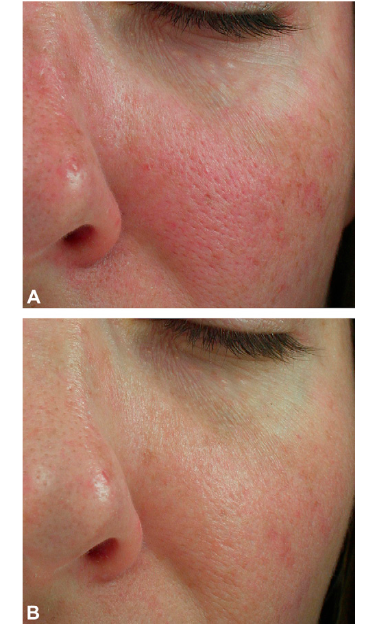 주사피부염(장미진)이 있는 피부과의사 - 어떤 레이저를 받을까? : 네이버 블로그