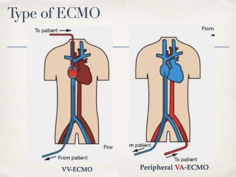 ECMO(ExtraCorporeal Membrane Oxygenator) - 체외막산소공급장치 총정리 : 네이버 블로그