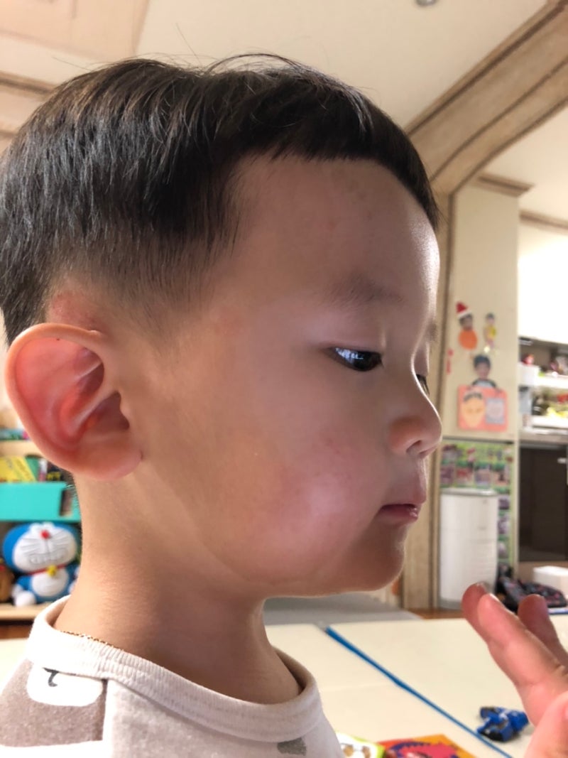 아기 밀크커피반점 갈색점 카페오레반점 레이저치료 경과 기록 네이버 블로그