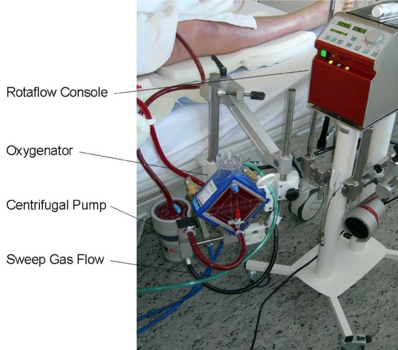ECMO(ExtraCorporeal Membrane Oxygenator) - 체외막산소공급장치 총정리 : 네이버 블로그