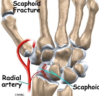 손목 골절 중 주상골 골절, scaphoid bone fracture : 네이버 블로그