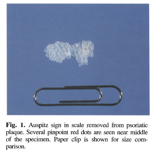 판상건선, 화폐상습진, 장미색비강진 - 인천피부한의원 : 네이버 블로그