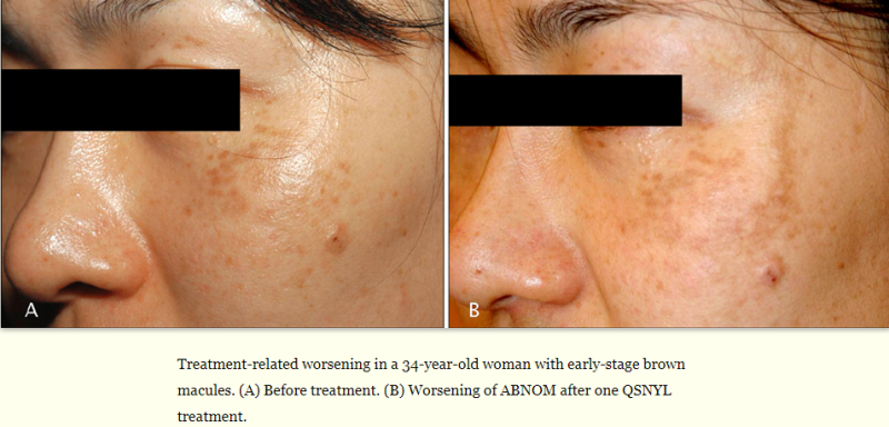 후천성 양측성 오타모반양 반점 (acquired bilateral nevus of Ota-like macules, ABNOM ...