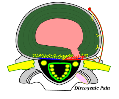 IDD(Internal Disc Disruption) : 네이버 블로그