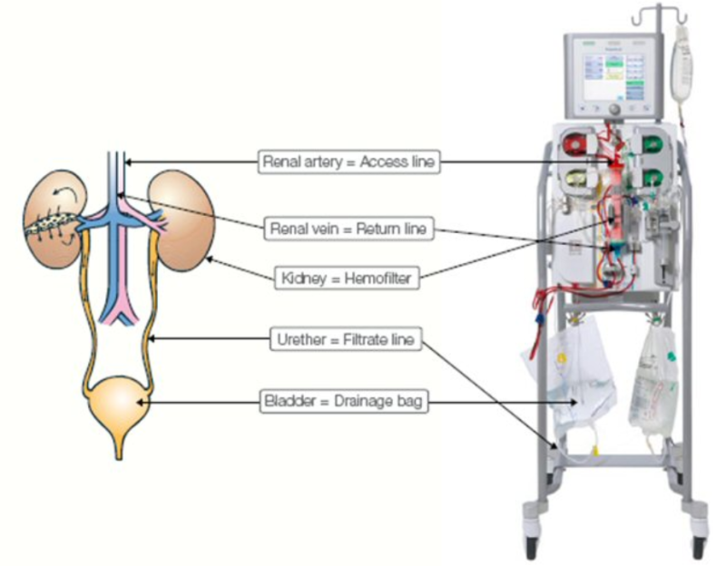 쉽게 이해하는 CRRT(Continuous Renal Replacement Therapy) : 네이버 블로그