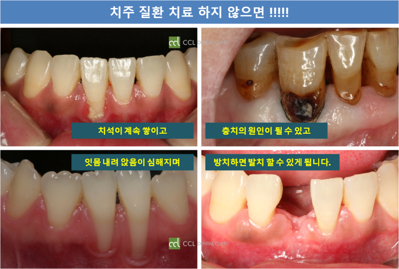 잇몸 염증 잇몸이 부었을 때 잇몸내려 앉음 등 잇몸병 증상과 치료 방법 잇몸치료 이식 수술 사례 네이버 블로그