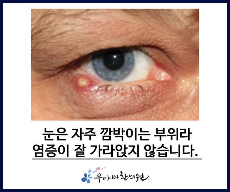 눈 다래끼 치료 간편하게 빠르게~ 네이버 블로그
