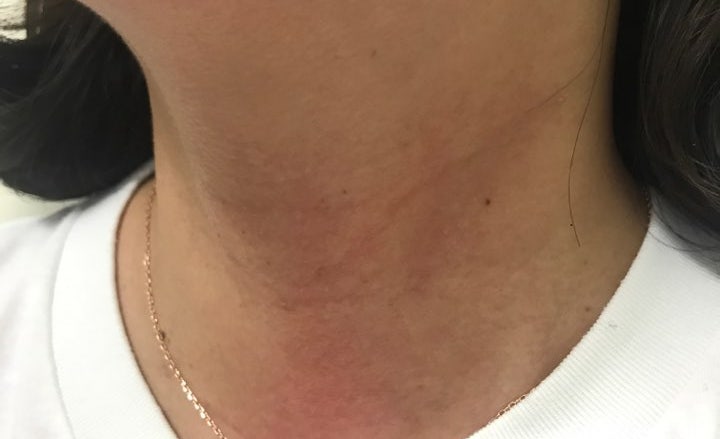 목의 색소 질환, 목의 때?, 마른땅 형 피부병 TFFD (Terra Firma-forme dermatosis) : 네이버 블로그