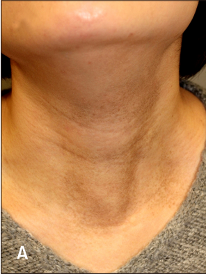 목의 색소 질환, 목의 때?, 마른땅 형 피부병 TFFD (Terra Firma-forme dermatosis) : 네이버 블로그