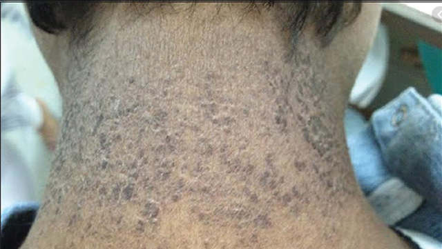 목의 색소 질환, 목의 때?, 마른땅 형 피부병 TFFD (Terra Firma-forme dermatosis) : 네이버 블로그