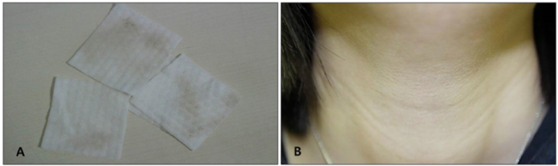 목의 색소 질환, 목의 때?, 마른땅 형 피부병 TFFD (Terra Firma-forme dermatosis) : 네이버 블로그