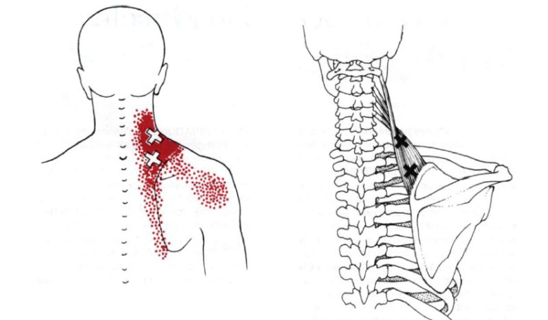 견갑거근과 능형근의 통증 유발점 [Trigger point of Levator scapular and Rhomboids ...