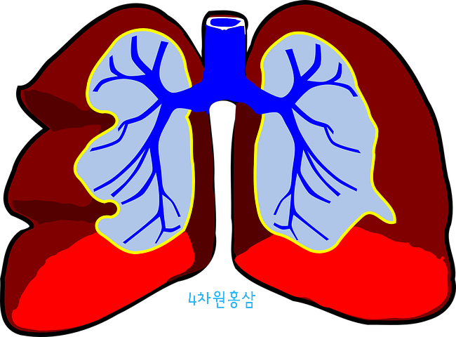 폐섬유화 폐섬유화증의 증상 원인 및 치료방법 네이버 블로그