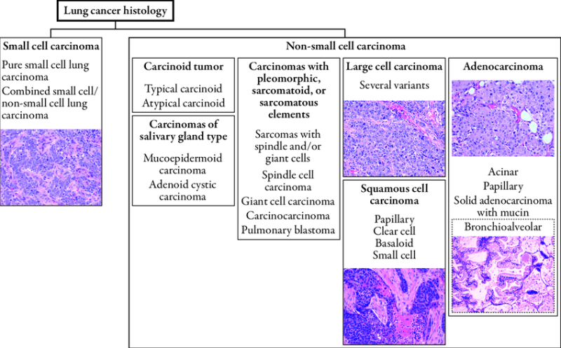 폐암의 병리학적 분류(Classification and Pathology of Lung Cancer) : 네이버 블로그