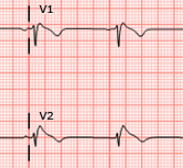 Brugada pattern(Brugada syndrome)의 심전도 : 네이버 블로그