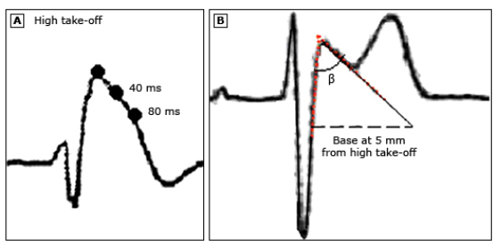 Brugada pattern(Brugada syndrome)의 심전도 : 네이버 블로그