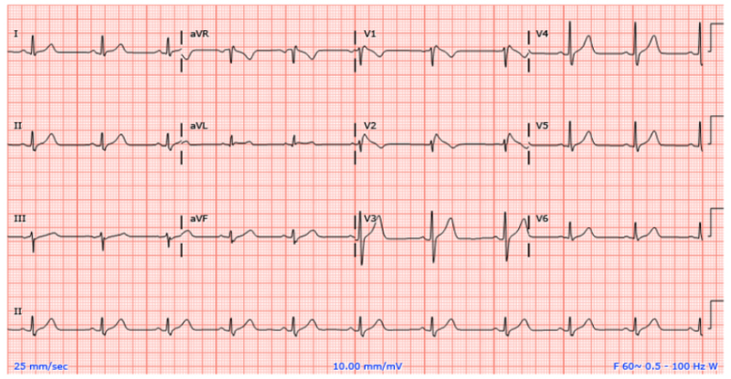 Brugada pattern(Brugada syndrome)의 심전도 : 네이버 블로그
