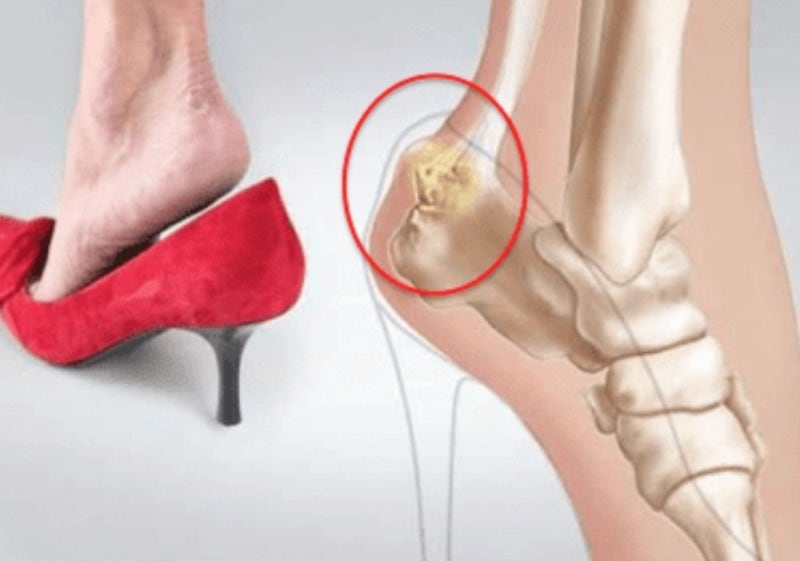 " 🔎발목 뒤꿈치 통증 : 하글랜드 변형 haglund deformity" 양산 물금 범어 증산 피티 재활 헬스 헬스장 ...