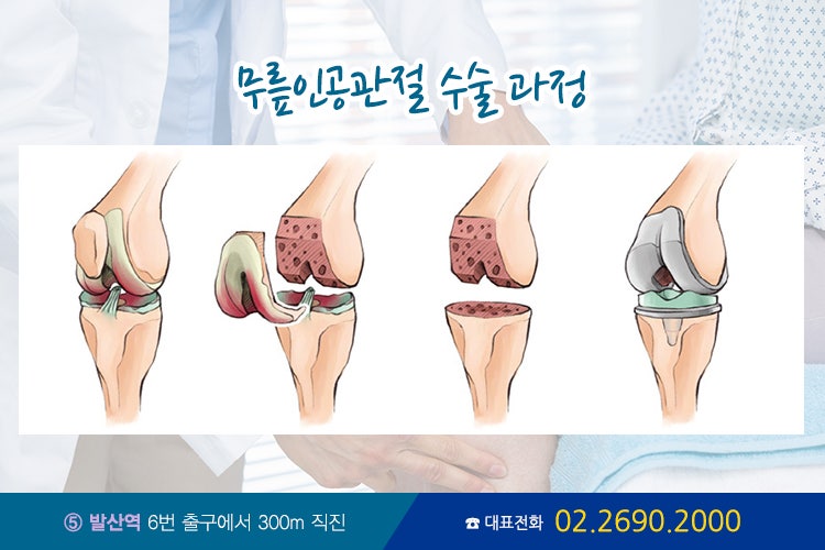 무릎인공관절수술 후 합병증 퇴원 후 주의사항 네이버 블로그