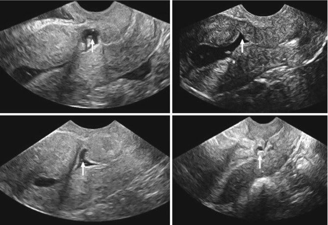 자궁의 제왕절개 흉터 결함 ; 자궁내시경적 치료 Hysteroscopic repair of cesarean scar ...