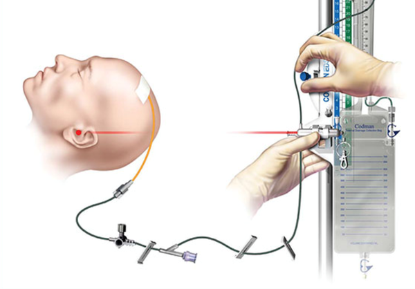 체외내실 배액 (EVD : external ventricular drainage) : 네이버 블로그