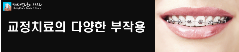 치아교정 부작용 무엇이 있는가 치아교정 전후 잇몸퇴축 치아 탈회 치근 흡수 블랙트라이앵글 By 닥터자일리톨