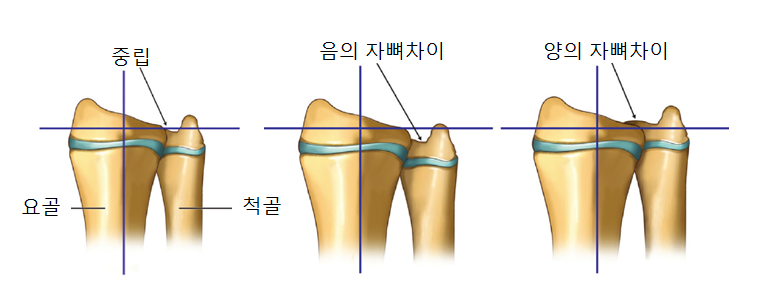 손목의 통증 3 삼각 섬유연골 복합체 Tfcc 손상 네이버 블로그