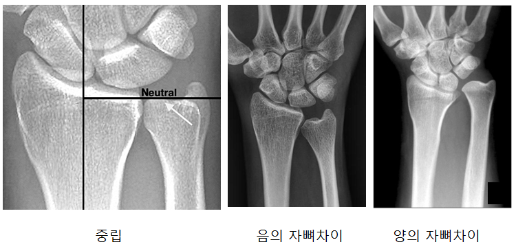 손목의 통증 3 삼각 섬유연골 복합체 Tfcc 손상 네이버 블로그