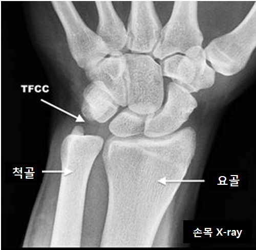 손목의 통증 3 삼각 섬유연골 복합체 Tfcc 손상 네이버 블로그