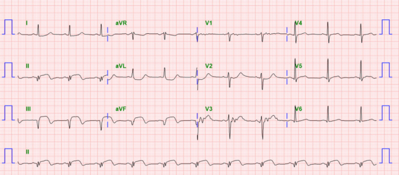 inferior wall STEMI (RCA territory) : 네이버 블로그