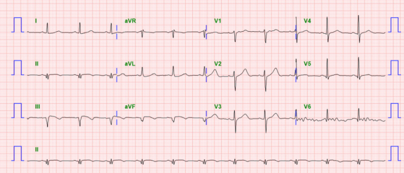 inferior wall STEMI (RCA territory) : 네이버 블로그