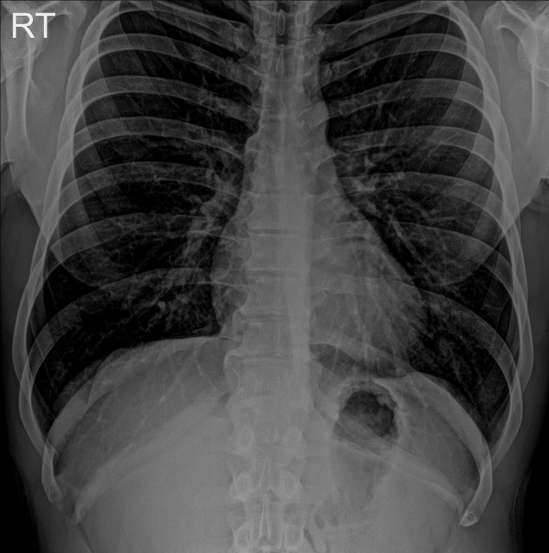 Pulmonary contusion - Rib fx 동반한 lung contusion 증례 : 네이버 블로그