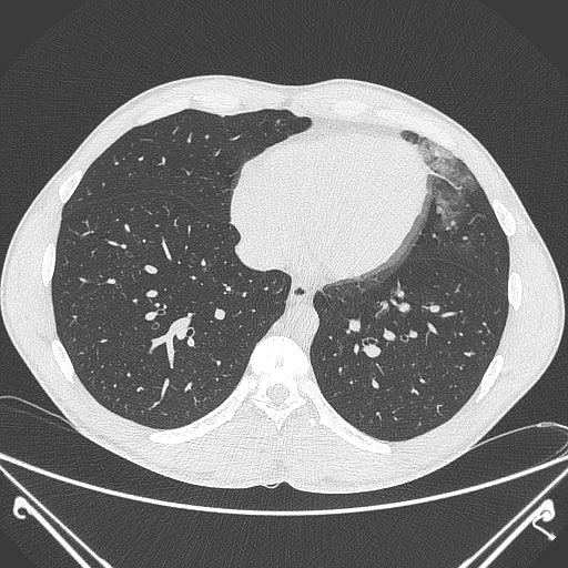 Pulmonary contusion - Rib fx 동반한 lung contusion 증례 : 네이버 블로그