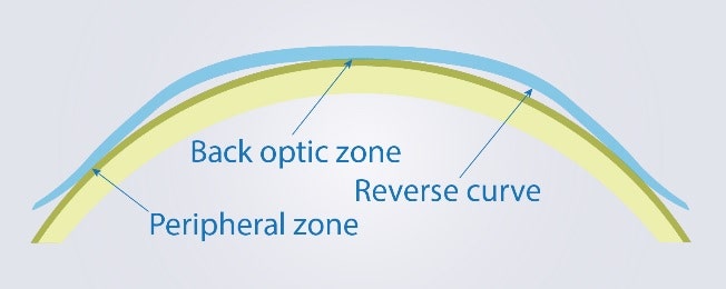 드림렌즈의 적당한 도수 결정은? : 네이버 블로그