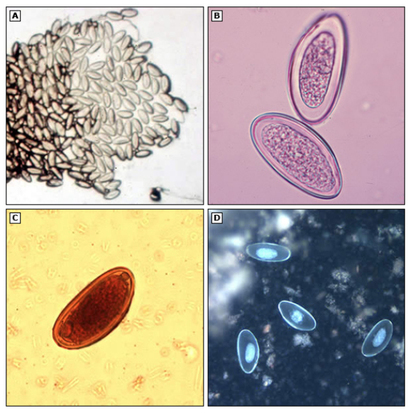 엔테로비우스 버미큘라리스 (요충), 증상과 진단, Enterobius vermicularis (pinworm), clinical ...