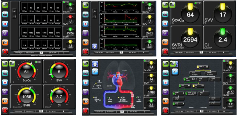 심장flow의 parameter. EV1000 - FloTrac sensor : 네이버 블로그