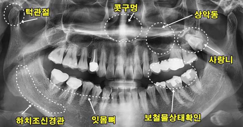 치과 엑스레이 종류 방사선사진 무엇이 있을까요 네이버 블로그