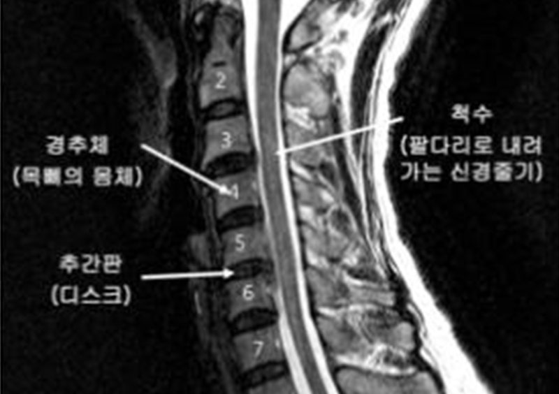 목디스크 초기증상 및 다양한 경추 질환의 통증협착증 후관절 증후군 흉곽출구증후군 두통 등 네이버 블로그