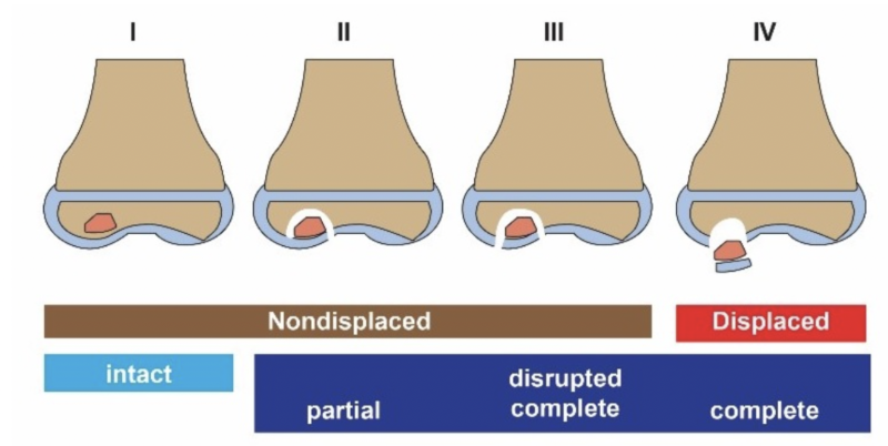 Knee Osteochondritis Dissecans무릎 박리성 골연골염 네이버 블로그