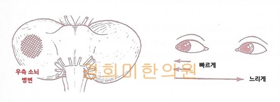 안구진탕눈동자 떨림 증상 원인 치료 네이버 블로그