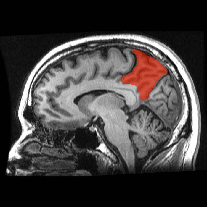 [우울증/변증] 같은 우울증 환자라도, 허증/실증에 따라 뇌기능에 차이있다: 우측 쐐기앞소엽(right precuneus ...