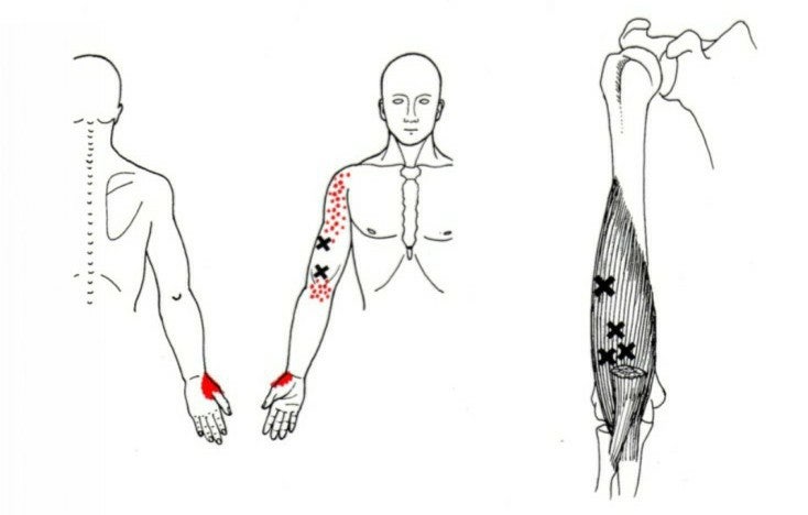상완이두근biceps Brachii 상완이두근 해부학 위팔두갈래근 네이버 블로그