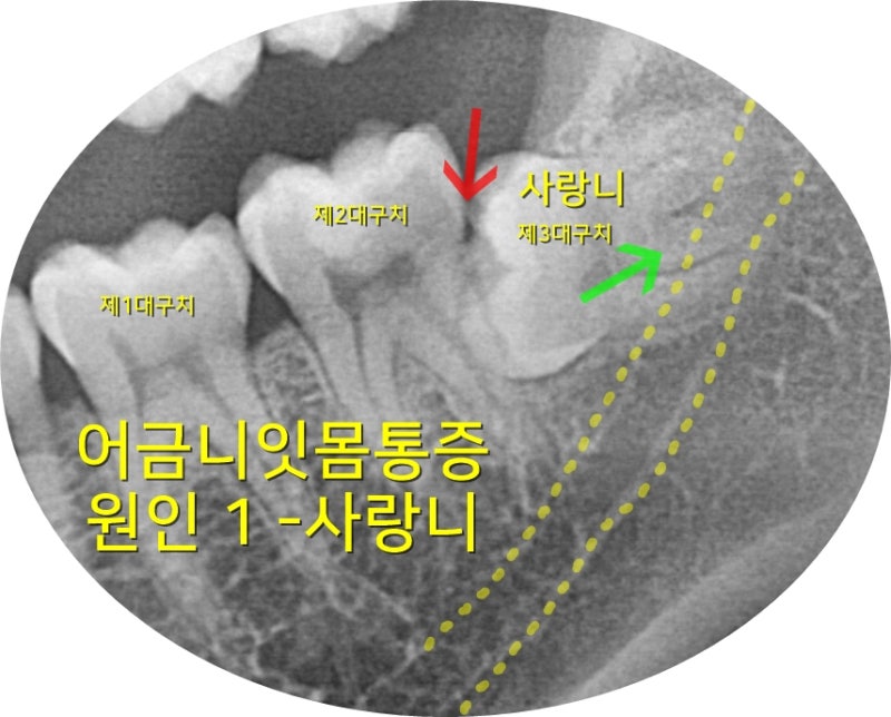 어금니잇몸통증 참는다고 해결될문제가 아닙니다 네이버 블로그